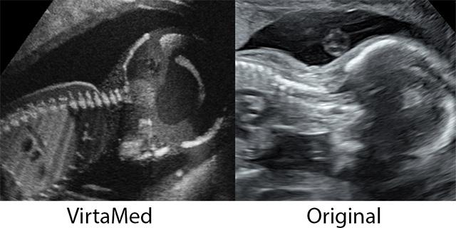 GynoS™ OB/GYN Ultrasound Training Module | VirtaMed