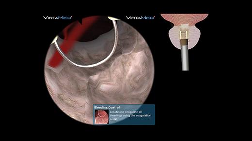 UroS™ simulator for urology procedures | TURP, TURB and Laser BPH ...